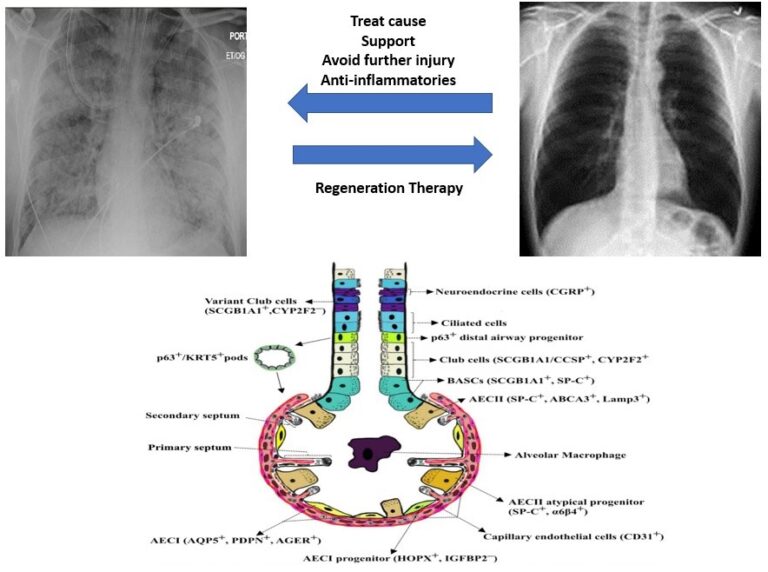 The missing piece: Lung regeneration therapy – Society of Mechanical ...